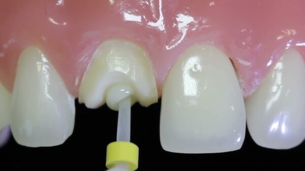 ¿Postes dentales de fibra de vidrio o pernos metálicos? - Centro ...